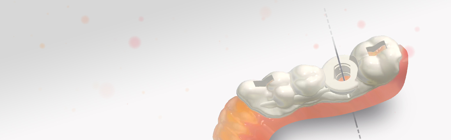 Guided Surgery - Global D