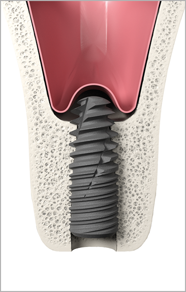 Sinus Lift - Global D