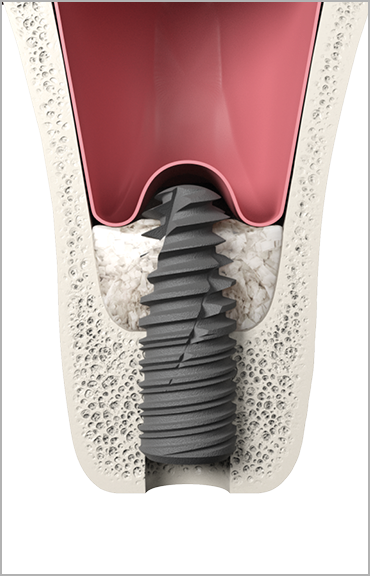 Sinus Lift - Global D