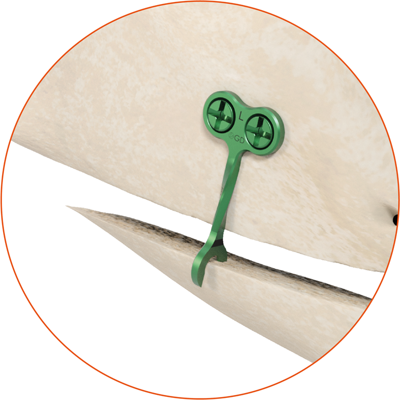 Chin Wing Genioplasty - Global D