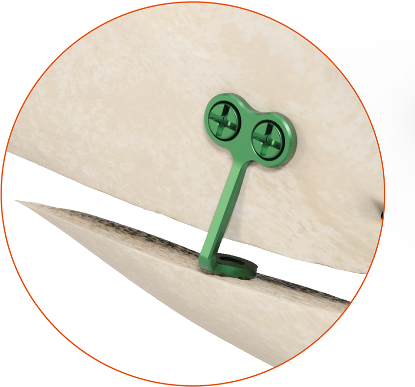 Chin Wing Genioplasty - Global D